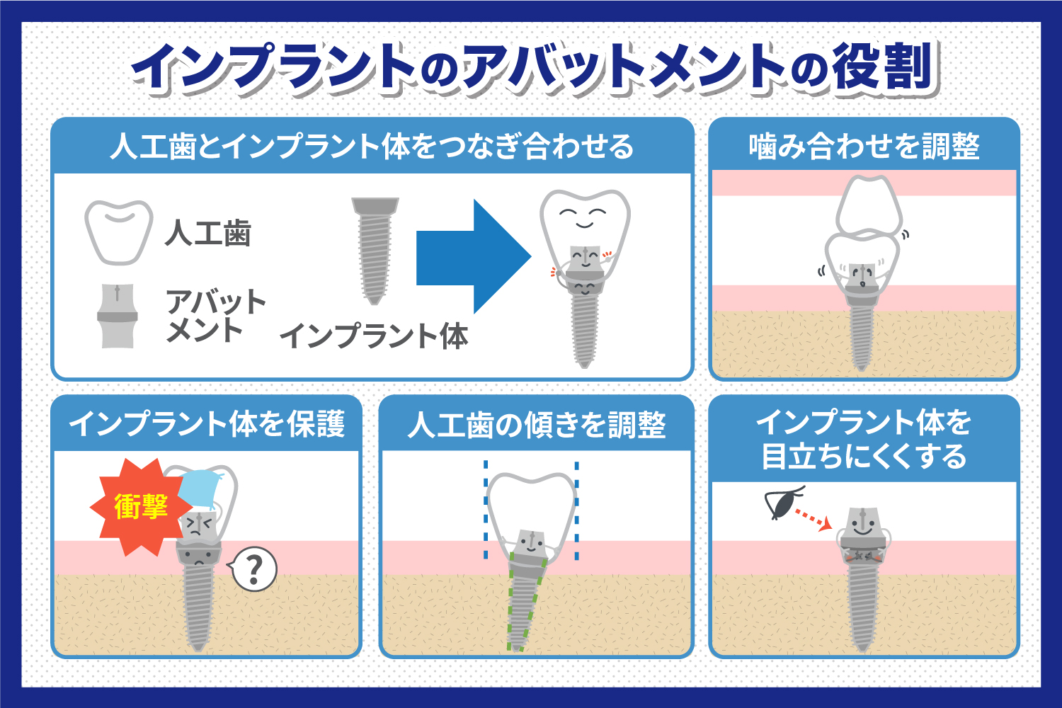 インプラントのアバットメントとは？ 5つの役割と4つの種類を解説｜名古屋歯科